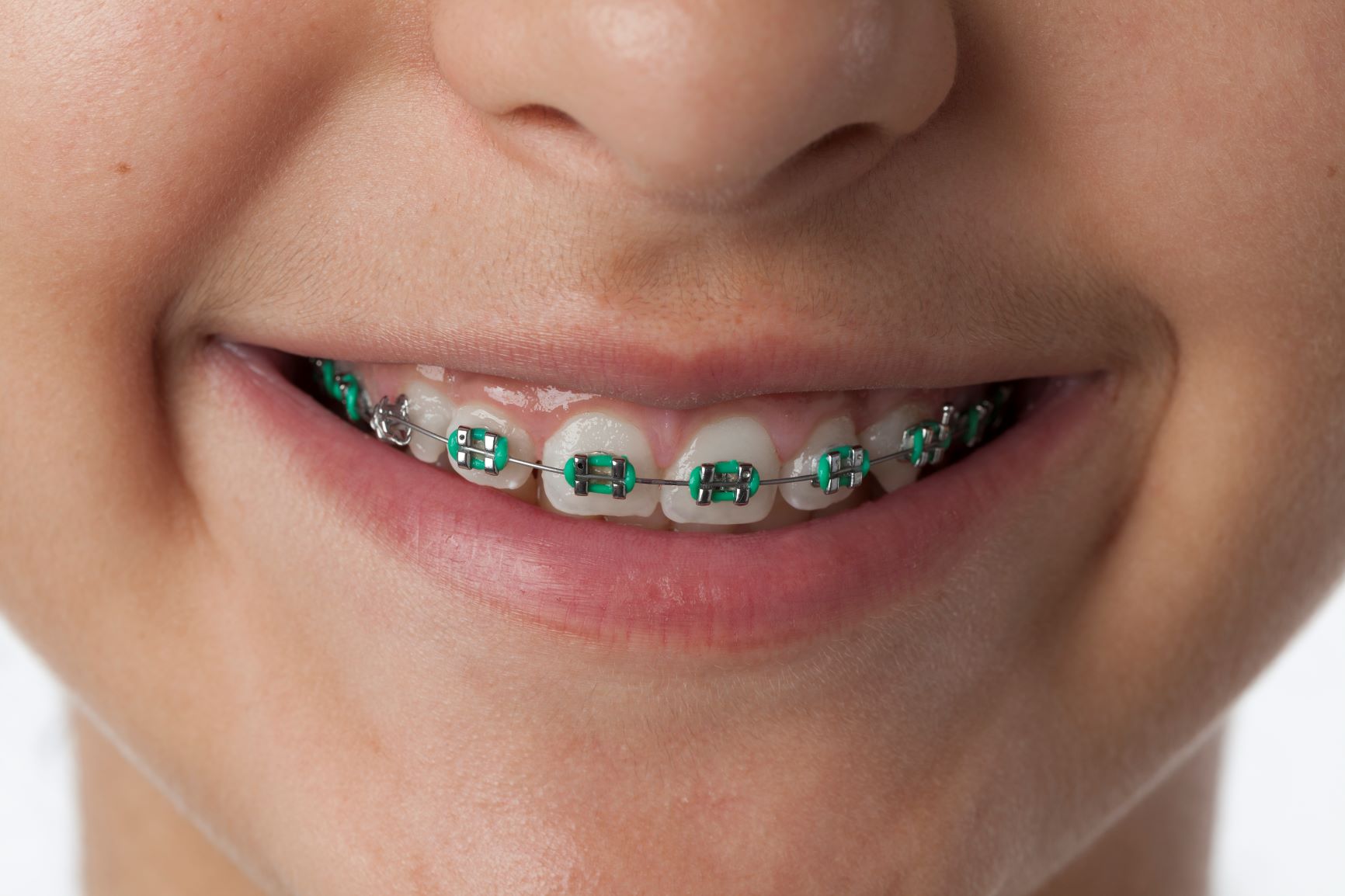 Tipos de brackets: ¿cuáles son los mejores? - Clinica Dental Carolina Lopez Tipos de brackets: ¿cuáles son los mejores? - Clinica Dental Carolina Lopez