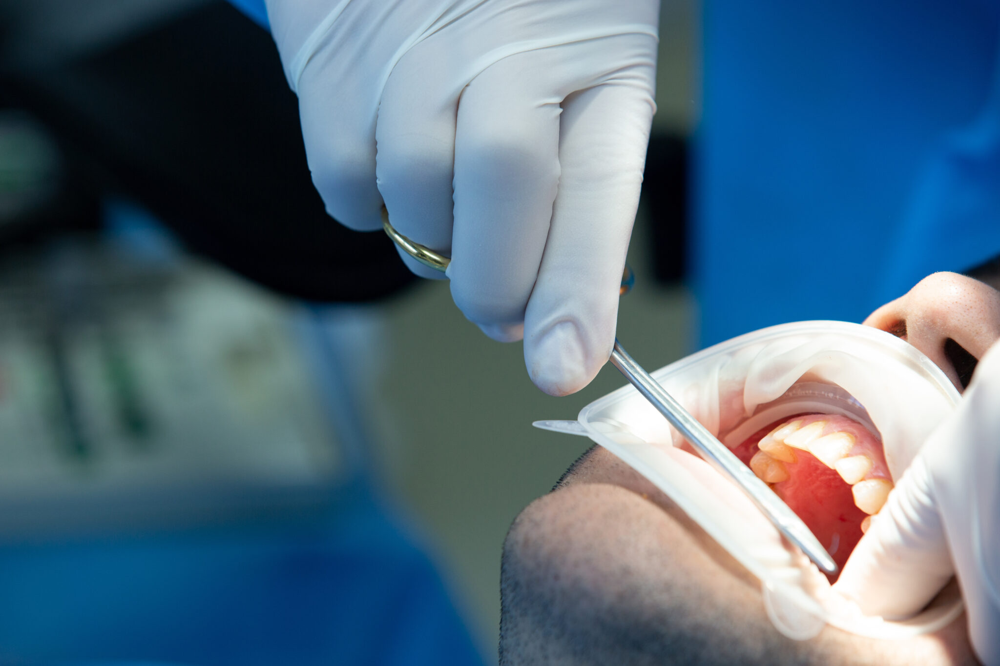 ¿Qué es la periodontitis? Síntomas, causas y tratamiento - Clinica Dental Carolina Lopez